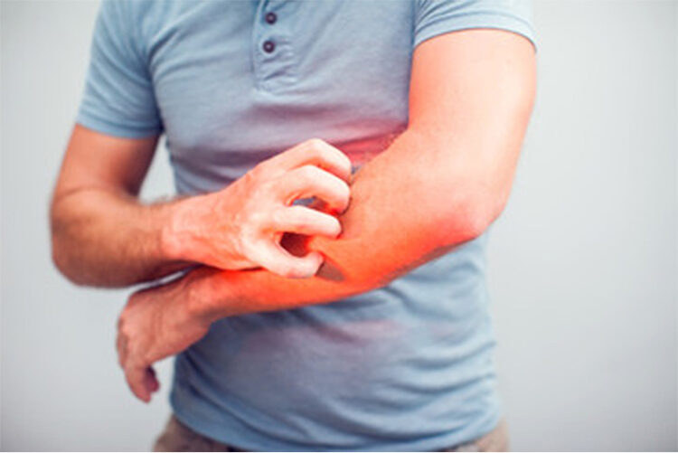 Psoriasis vs Eczema: Differences, Types & Best Treatments